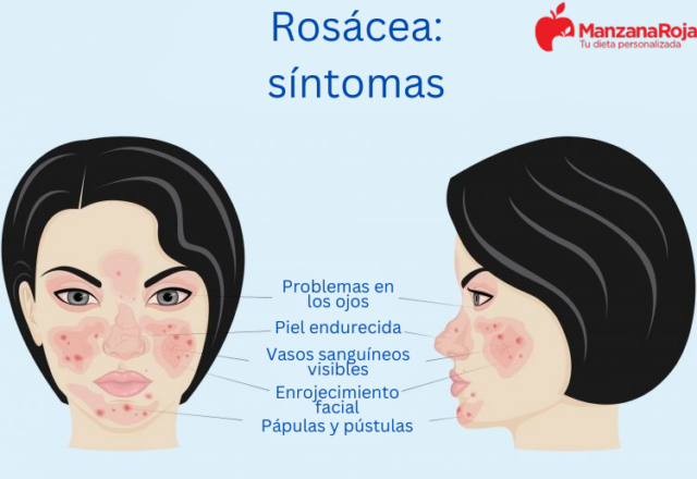 Descubre Todo Sobre La Rosácea: Causas, Síntomas Y Tratamientos – DKZHGJ